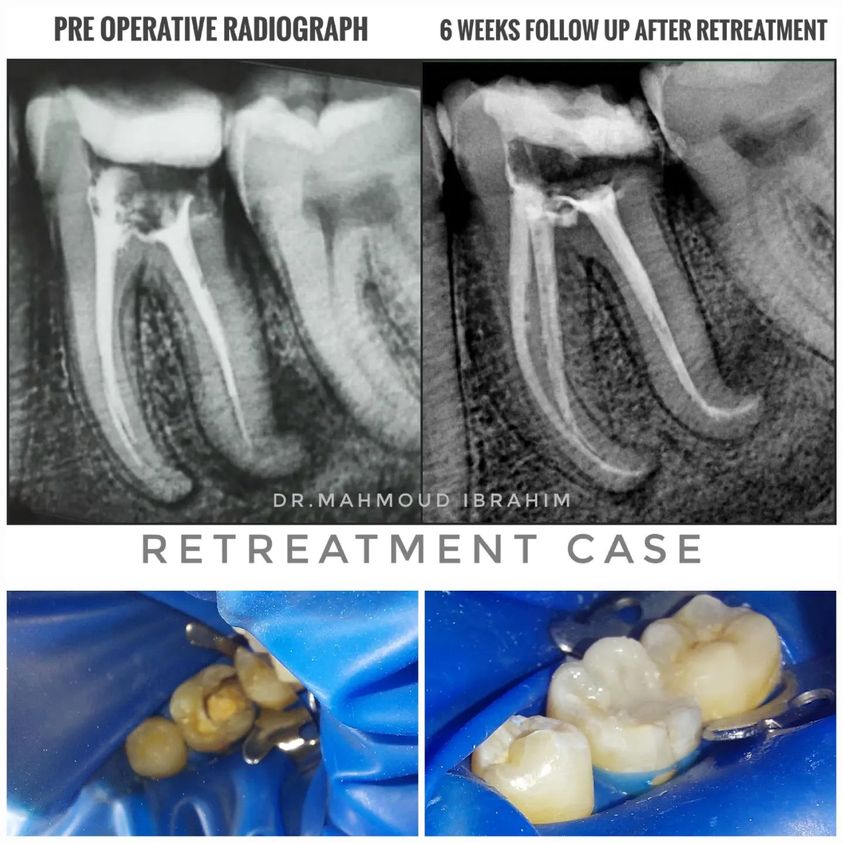 Retreatment Files-Endodontic Instruments For Removing - RoginDental