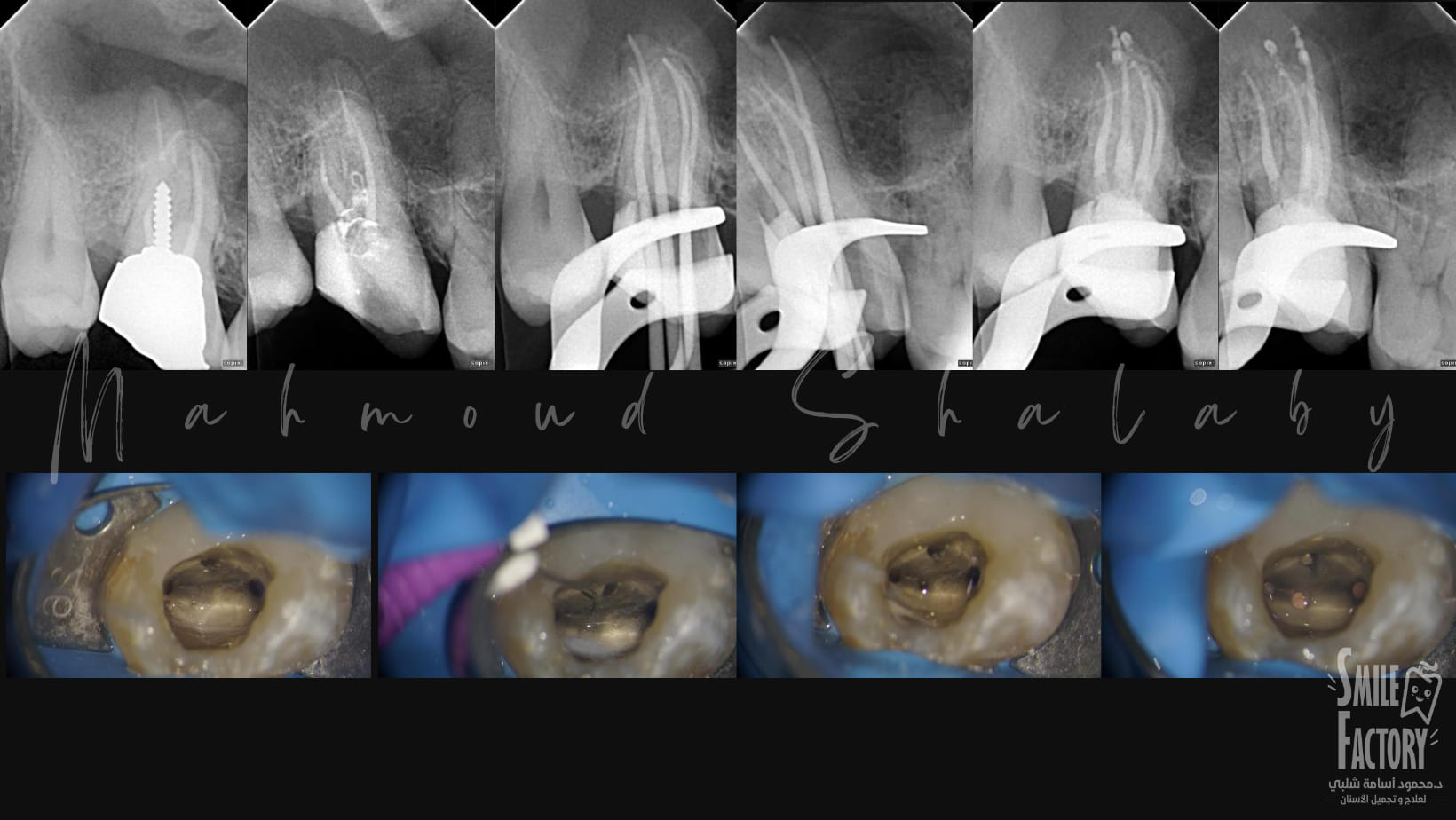 Retreatment Files-Endodontic Instruments For Removing - RoginDental