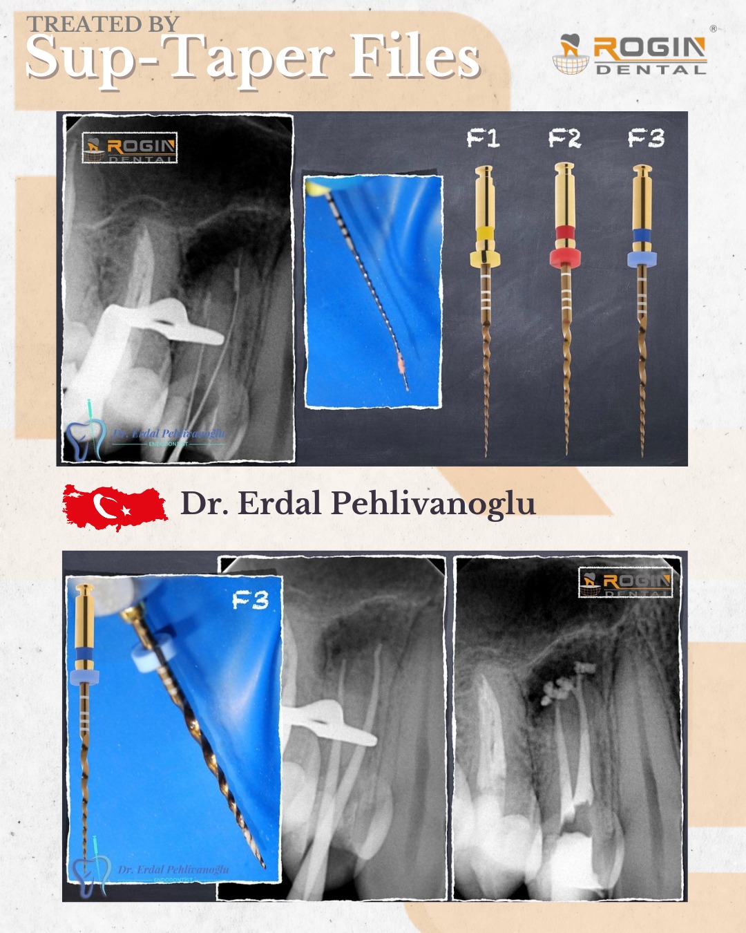 A Case Is About Sup-Taper Files(Gold) - Rogindental