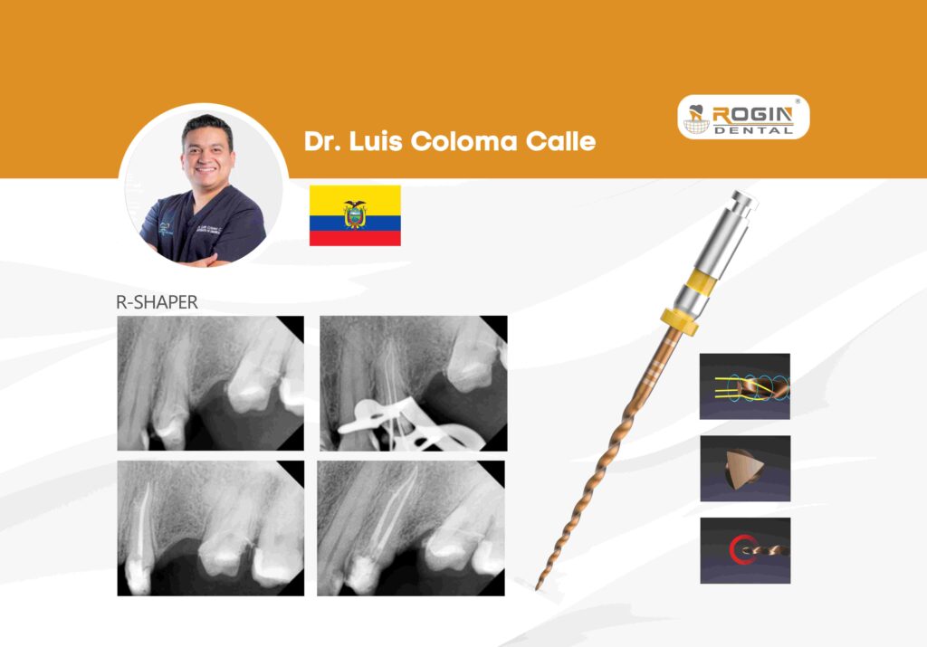 Abordaje Endodóntico De Casos De Canal Calcificado Con Curvaturas ...