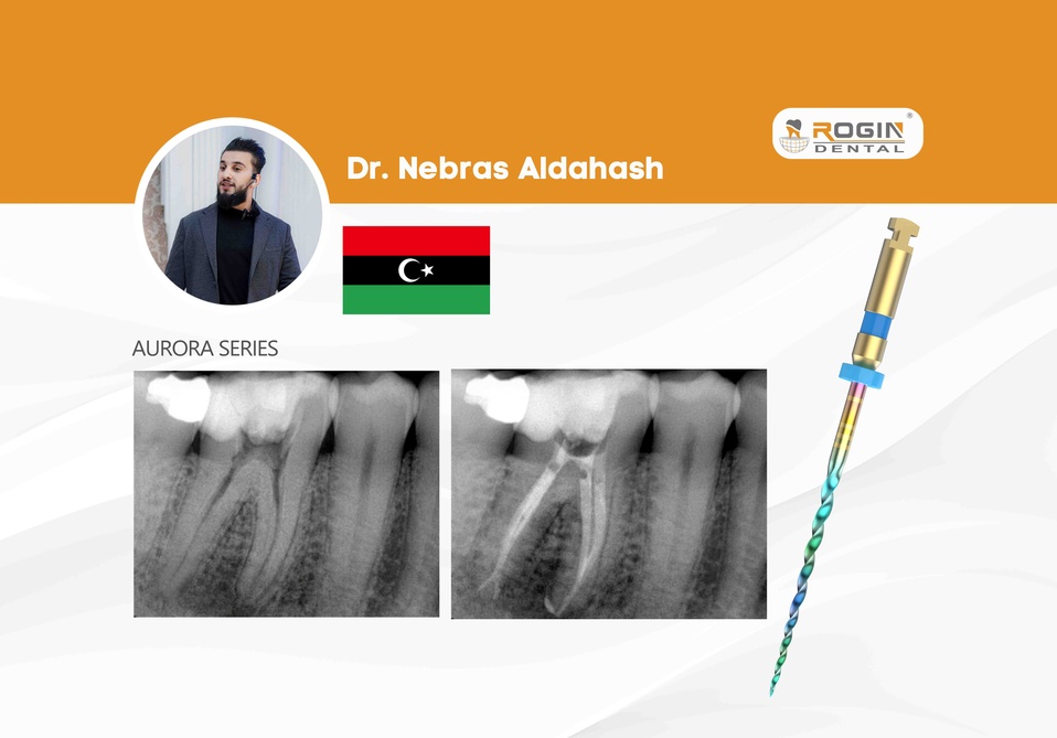 Successful Endodontic Management Of A Complex Mandibular First Molar ...
