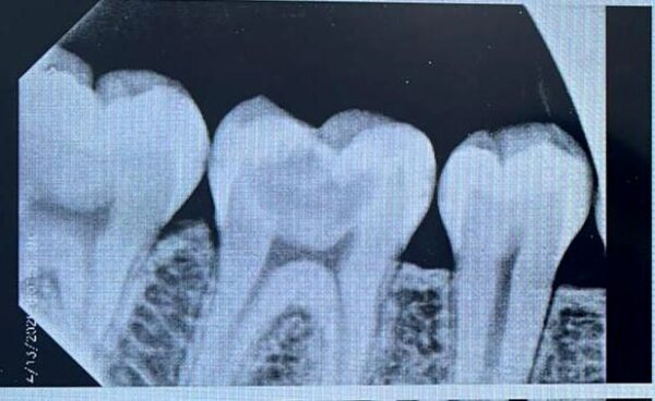 Successful Single-Visit Root Canal Treatment: A Case Study Of ...