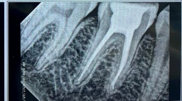 Successful Single-Visit Root Canal Treatment: A Case Study Of ...